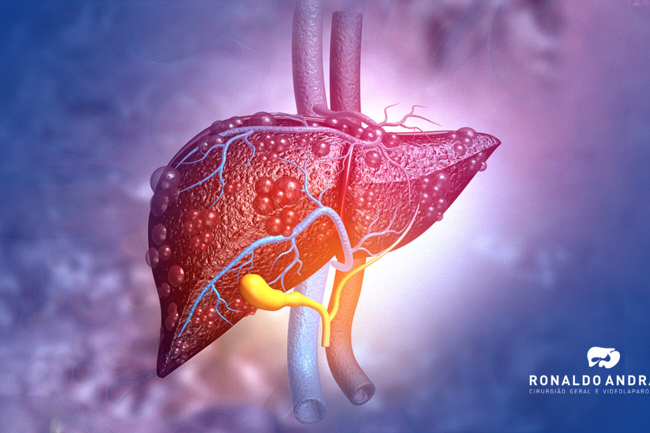 Você conhece as causas da Cirrose? - Dr. Ronaldo Andrade
